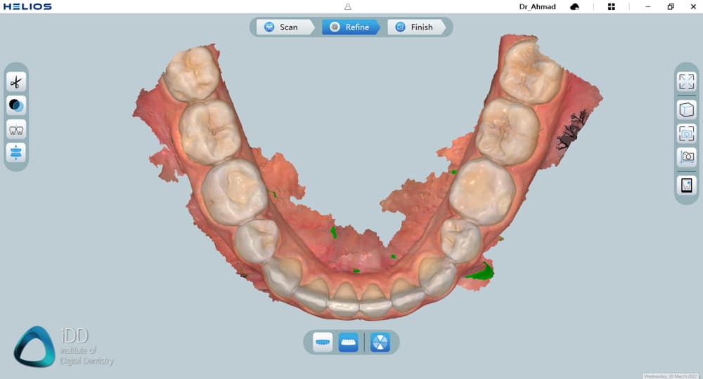 Helios 600 Intraoral Scanner Review | Institute of Digital Dentistry