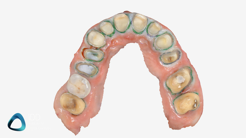 We Reviewed the Runyes 3DS 3.0 Intraoral Scanner
