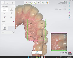 How to 3D Print Splints and Nightguards using Keysplint Soft ...