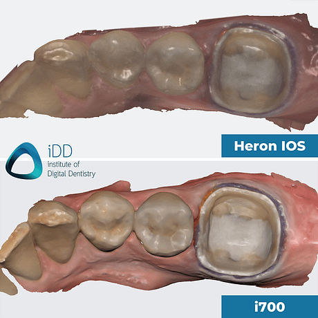 3DISC Heron Intraoral Scanner Review | Institute of Digital Dentistry