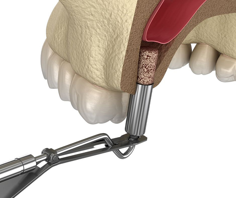 Learn Digital Implantology | Institute Of Digital Dentistry