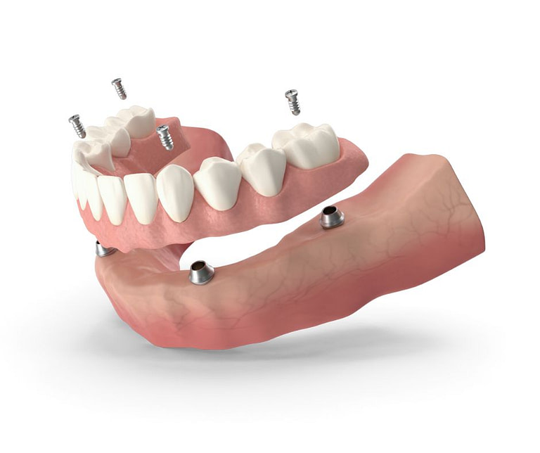 Learn Digital Implantology | Institute Of Digital Dentistry