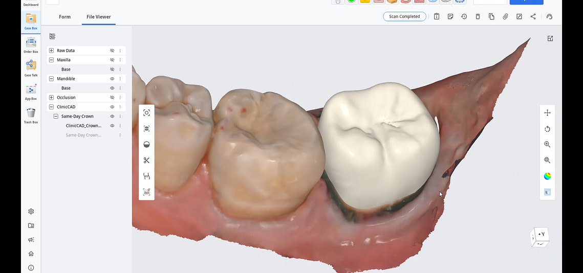 Single-Visit Milled Restorations using Medit ClinicCAD - Institute of ...
