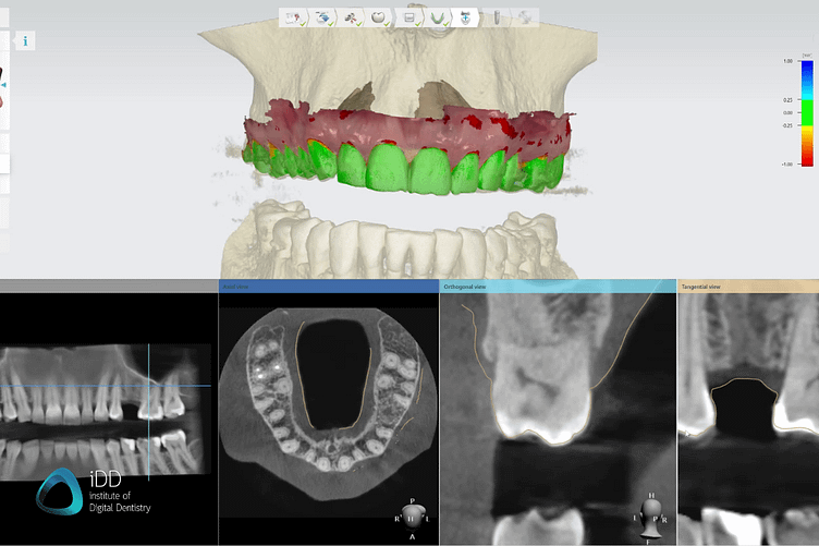 How to 3D Print Implant Surgical Guides for Stress-Free Implant ...