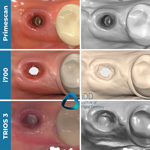 Intraoral Scanner Comparison - Scan Body and Implant Scans