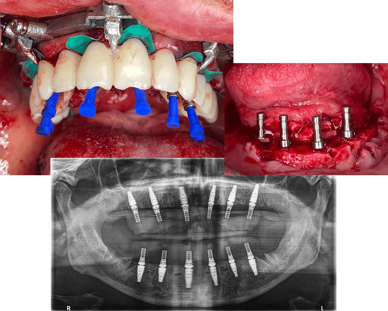 Ultimate All-on-X Implant online course by Dr Mark Bishara