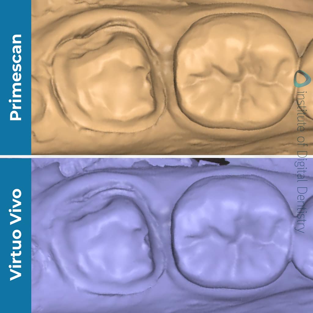 iDD Compares: Dentsply Sirona CEREC Primescan vs. Straumann Virtuo Vivo ...