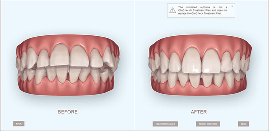 iTero Element 5D Plus Review | Digital Dentistry Blog | Online Courses