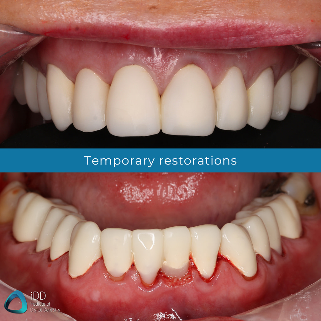 A Digital Approach to a Full Mouth Rehabilitation - Institute of ...