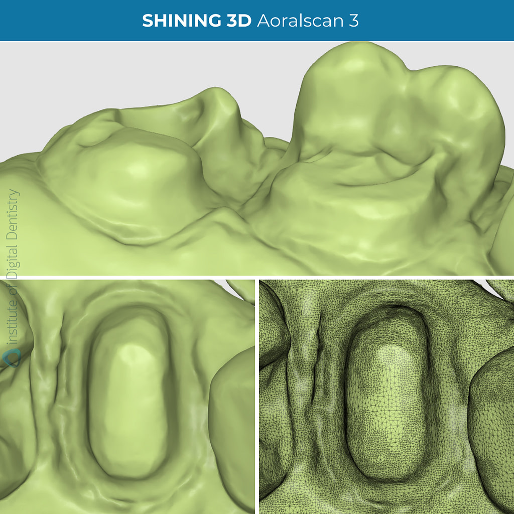 iDD Compares: Affordable vs Expensive Intraoral Scanners - Institute of ...