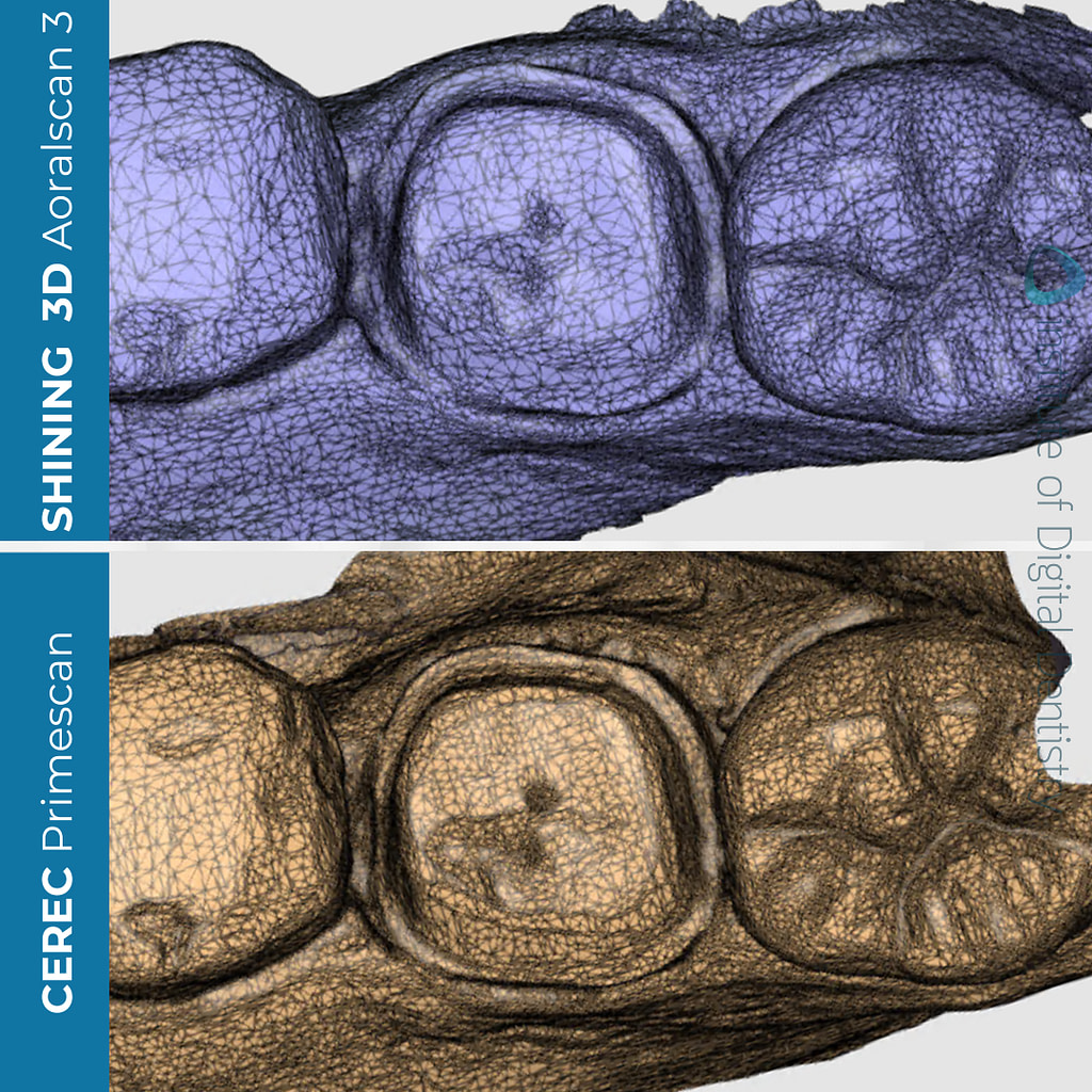 Shining 3D Aoralscan 3 vs. CEREC Primescan