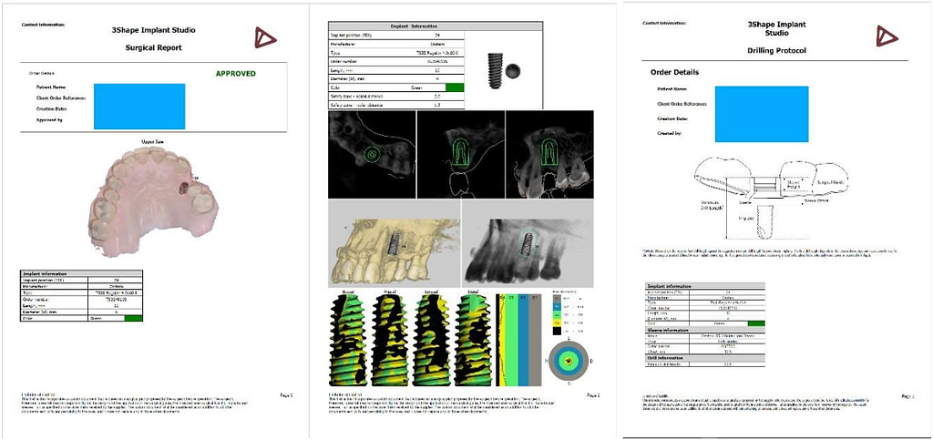 Dental Implant Treatment from Start to Finish using 3Shape TRIOS