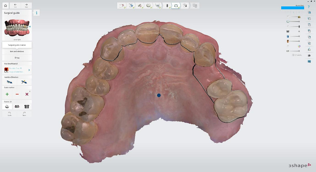 Dental Implant Treatment from Start to Finish using 3Shape TRIOS