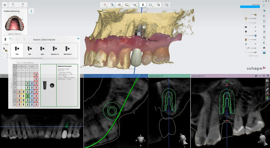 Dental Implant Treatment from Start to Finish using 3Shape TRIOS