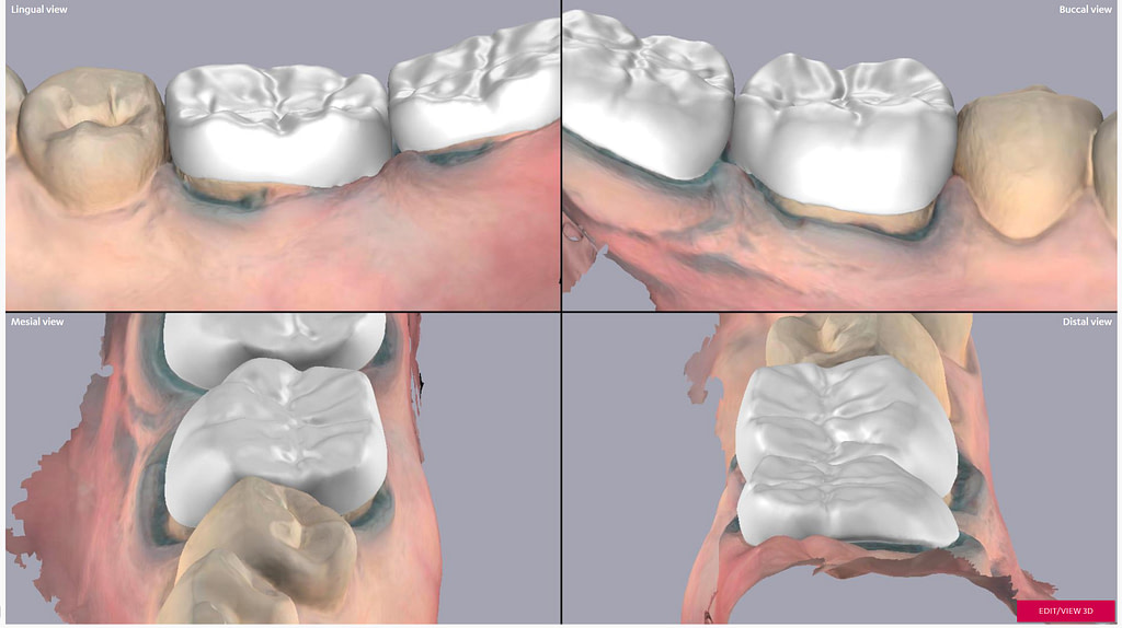 3Shape TRIOS 5 Intraoral Scanner Review