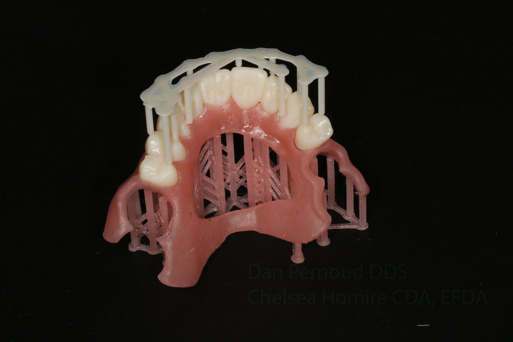 Graphy Tera Herz Flexible Base - Printed Partial Denture Review