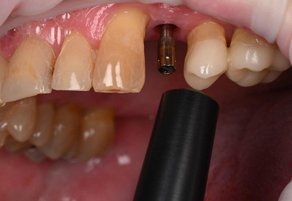 Dental Implant Treatment from Start to Finish using 3Shape TRIOS
