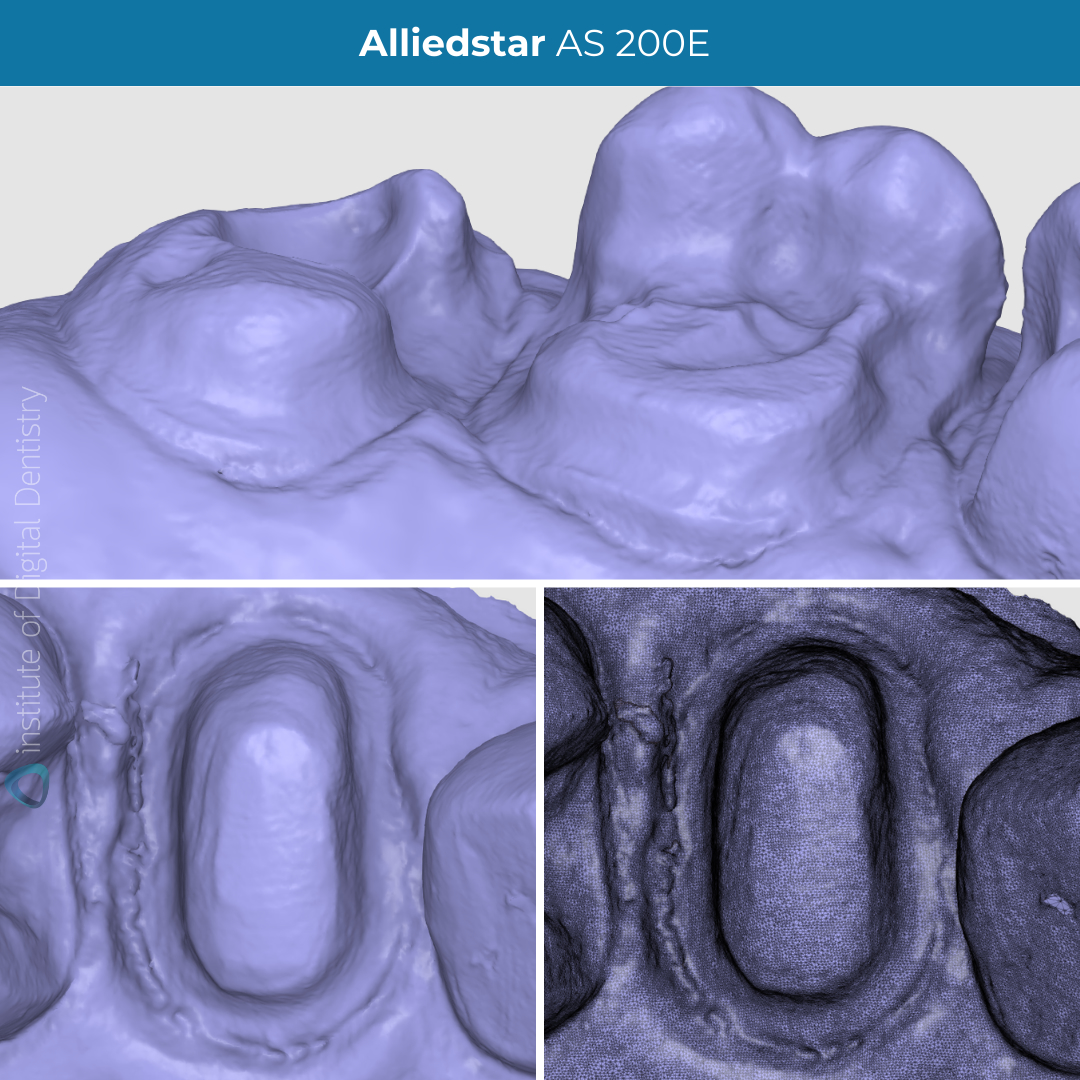 iDD Compares: Affordable vs Expensive Intraoral Scanners - Institute of ...