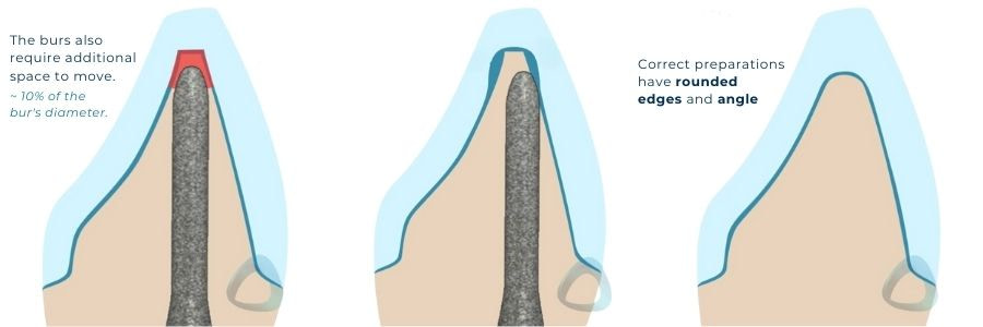 The Impact of Rounded Preps on Dental Restorations