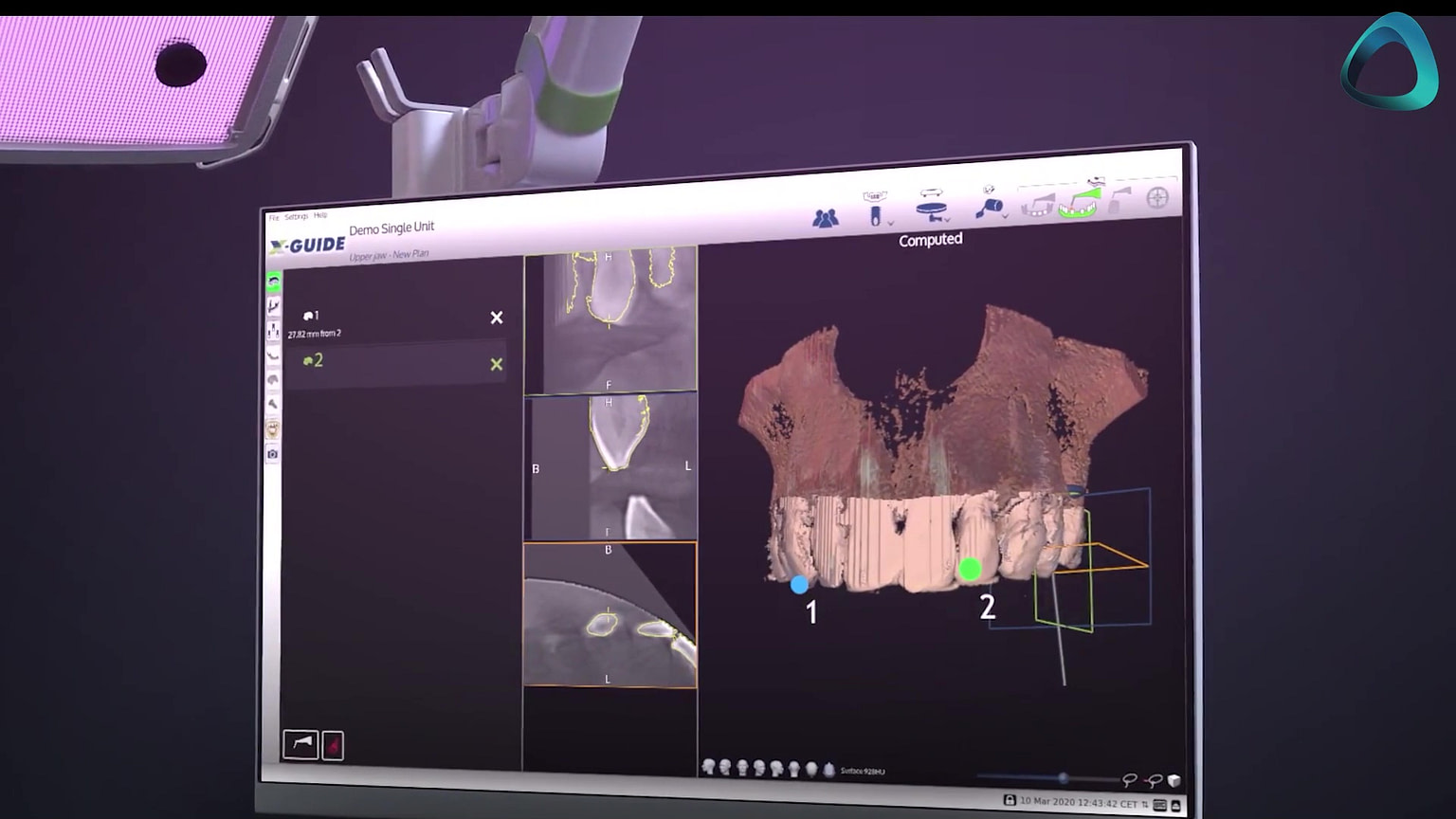 Our First X-Guide Implant Surgery - Institute of Digital Dentistry