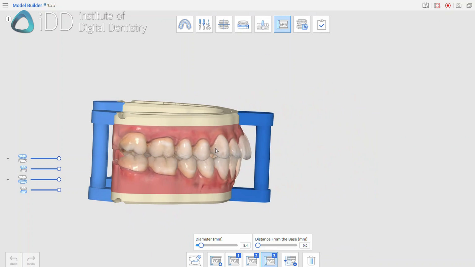 How to 3D Print Dental Models with iDD
