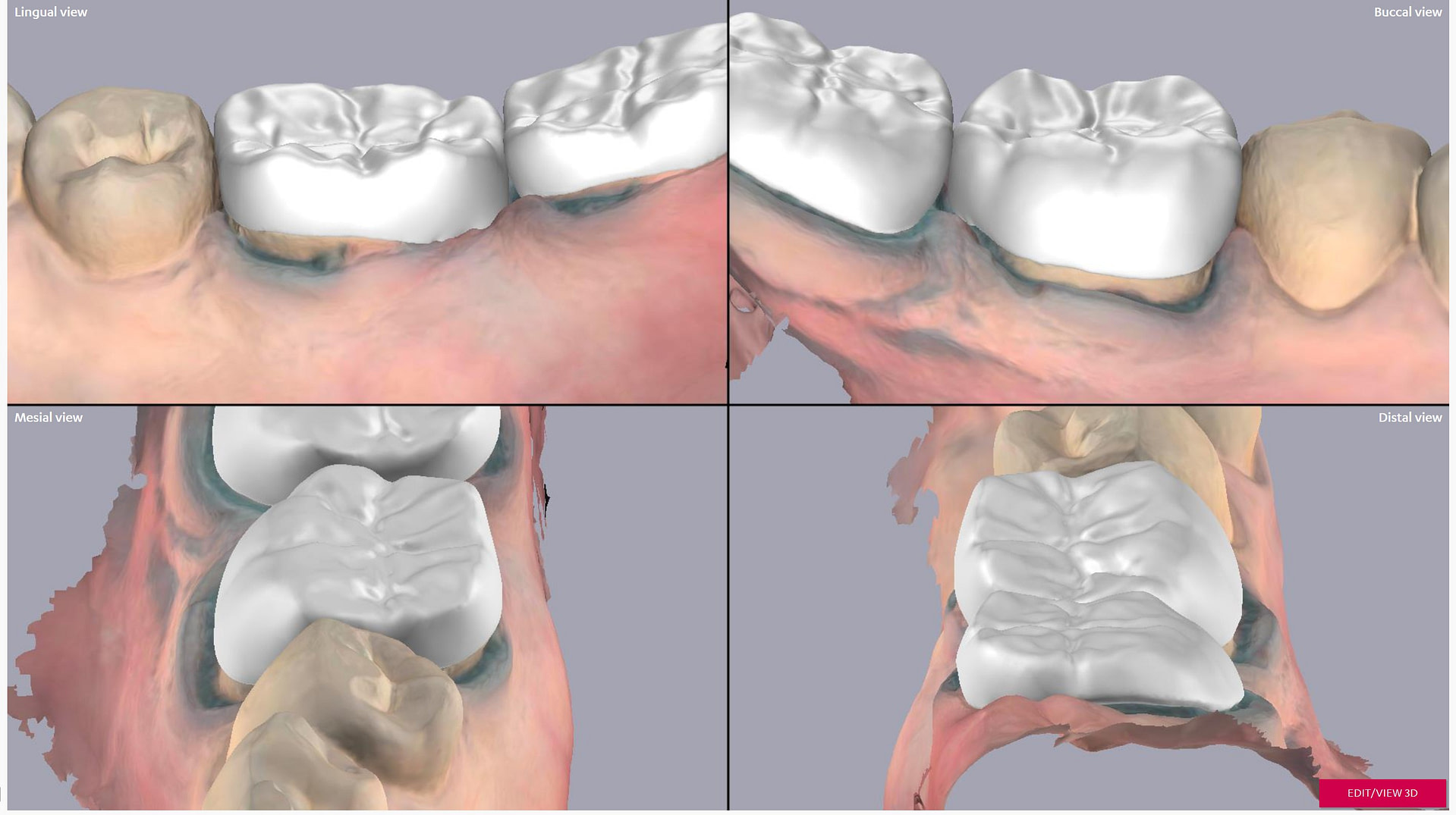 3Shape TRIOS 5 Intraoral Scanner Review