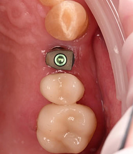 Dental Implant Treatment from Start to Finish using 3Shape TRIOS