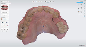 Dental Implant Treatment from Start to Finish using 3Shape TRIOS