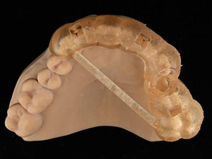 Dental Implant Treatment from Start to Finish using 3Shape TRIOS