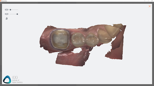 3DISC Heron Intraoral Scanner Review | Institute of Digital Dentistry