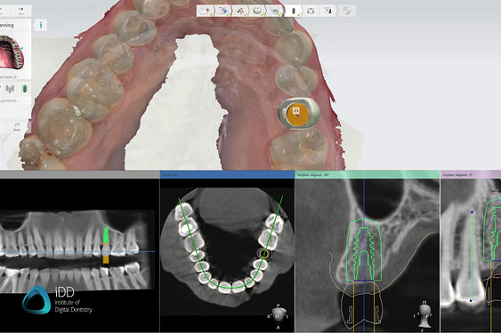 Guided vs. Non-Guided Dental Implant Surgery