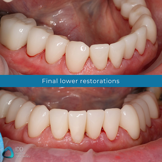 A Digital Approach to a Full Mouth Rehabilitation - Institute of ...