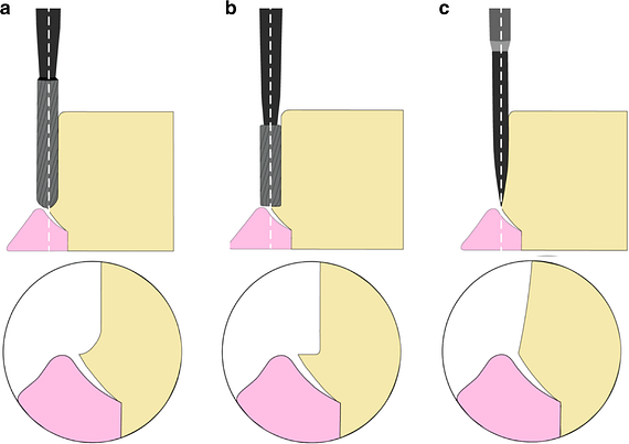 The Impact of Rounded Preps on Dental Restorations