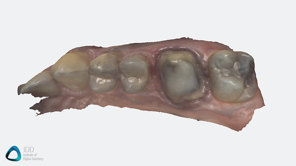 3DISC Heron Intraoral Scanner Review | Institute of Digital Dentistry