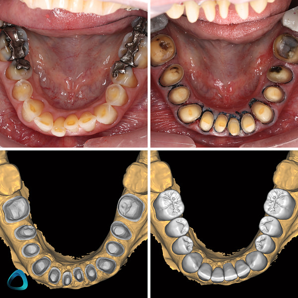 A Digital Approach to a Full Mouth Rehabilitation - Institute of ...