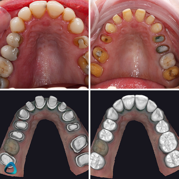 A Digital Approach to a Full Mouth Rehabilitation - Institute of ...