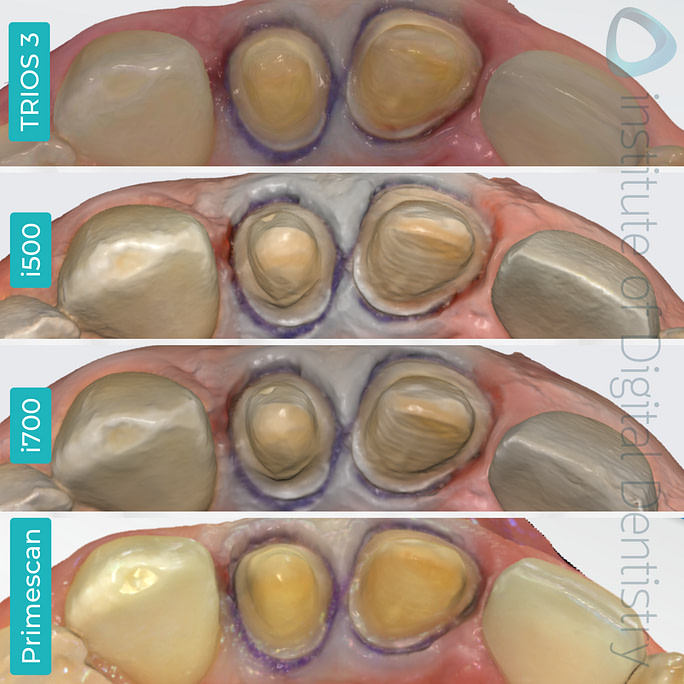 We Compared Older Generation Intraoral Scanners