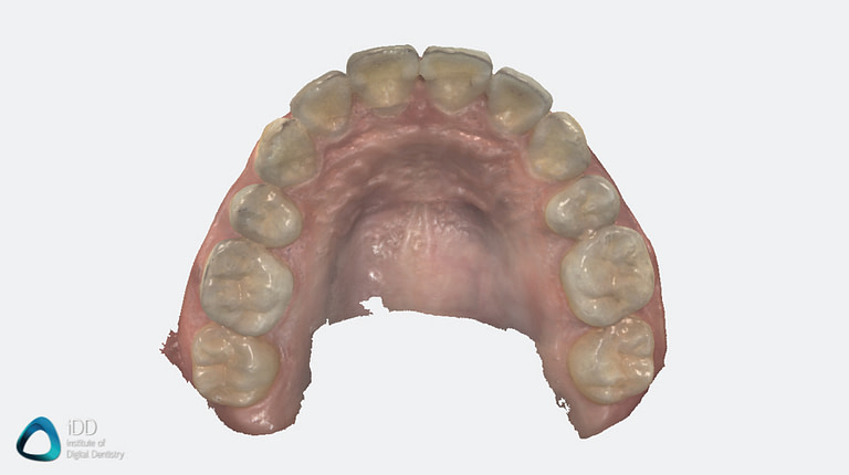 3DISC Heron Intraoral Scanner Review | Institute of Digital Dentistry