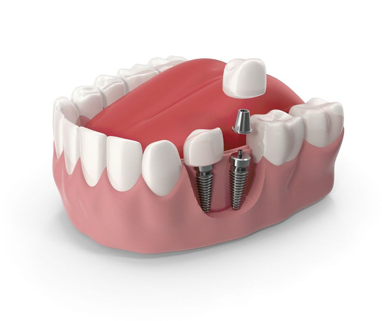 Learn Digital Implantology | Institute Of Digital Dentistry