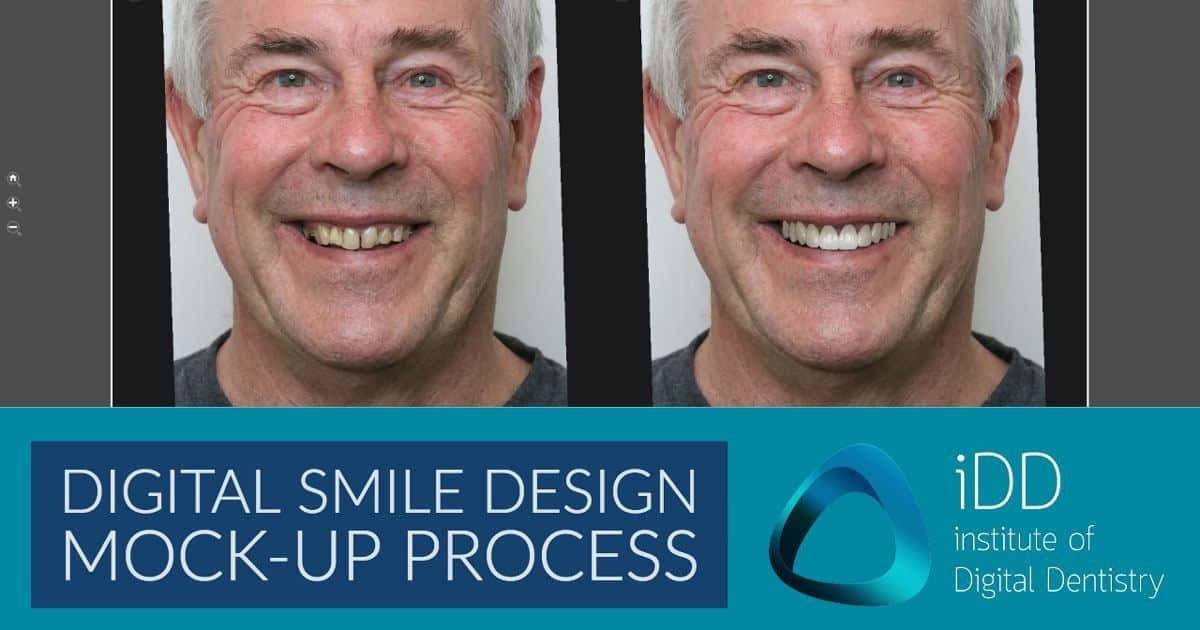 Digital Smile Design Mockup Digital Dentistry Blog Online Training