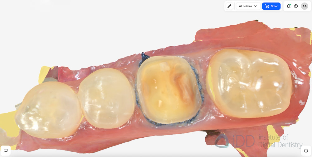 Primescan 2 Intraoral Scanner Review by iDD