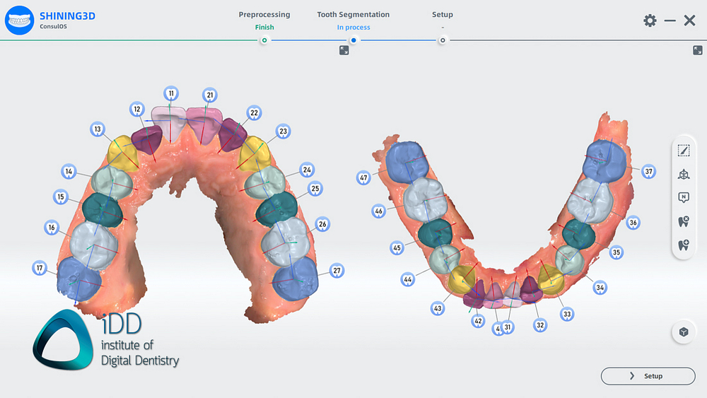 Shining 3D Aoralscan Elite Review by iDD