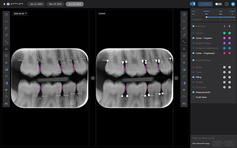 Second Opinion by Pearl Review. Dental AI Assisted Diagnostics!