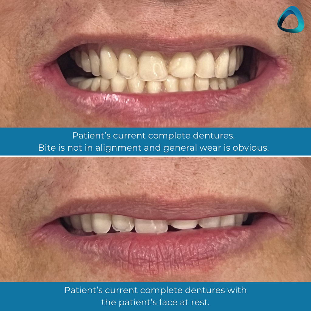 Digital Workflows for Digital Dentures