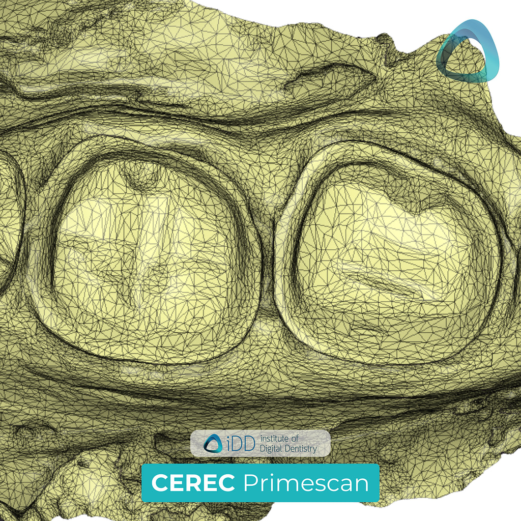 CEREC Omnicam vs. CEREC Primescan vs. Medit i900