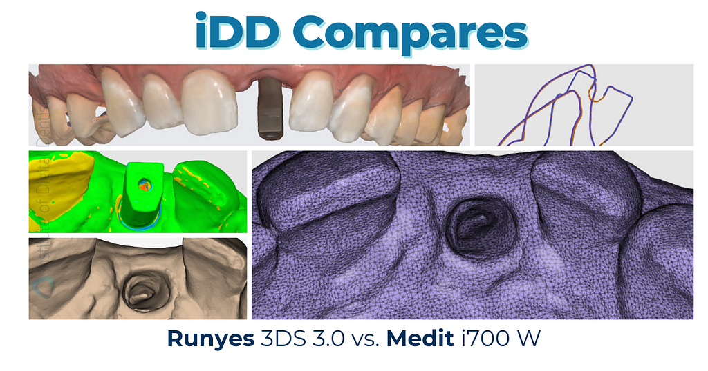 iDD Compares: Runyes 3DS 3.0 vs. Medit i700