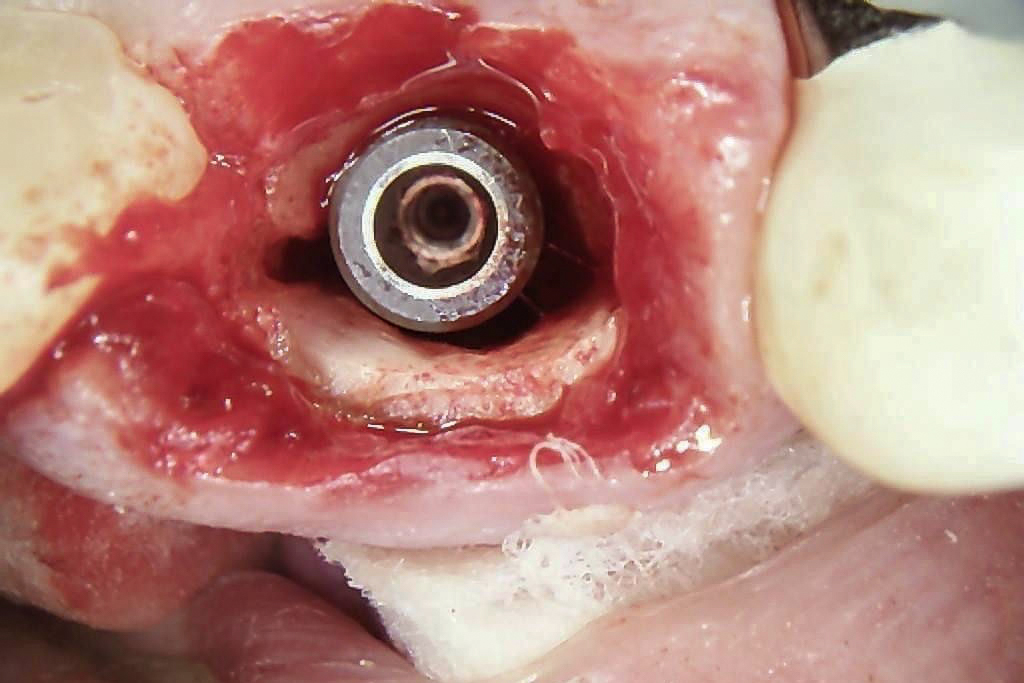 Partial Extraction Therapies & Socket Shield Course - Institute of ...