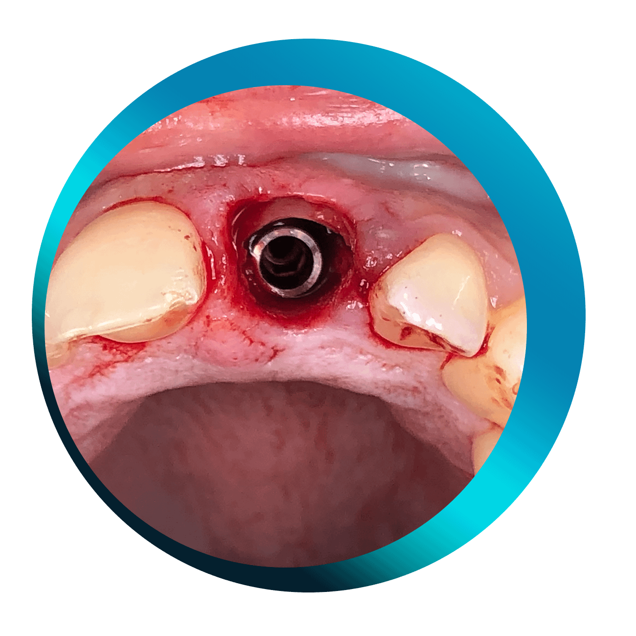Partial Extraction Therapies & Socket Shield Course - Institute of ...