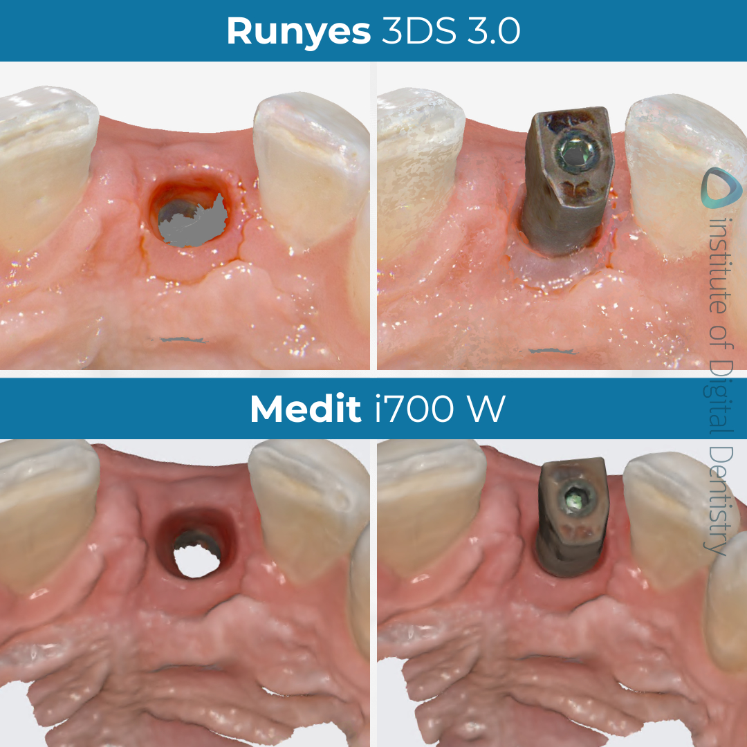 iDD Compares: Runyes 3DS 3.0 vs. Medit i700