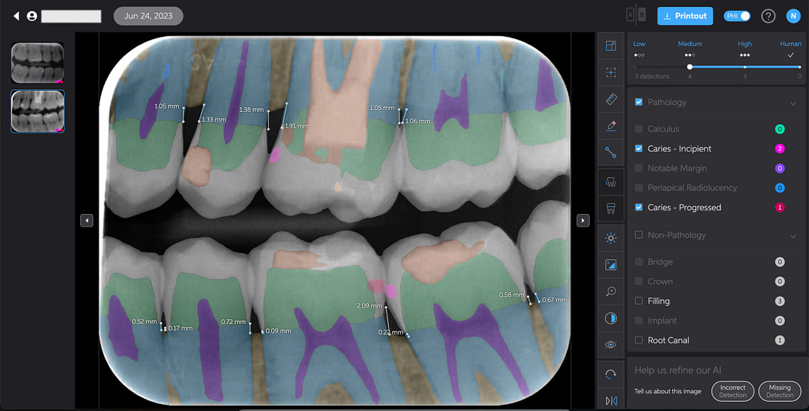 Second Opinion by Pearl Review. Dental AI Assisted Diagnostics!
